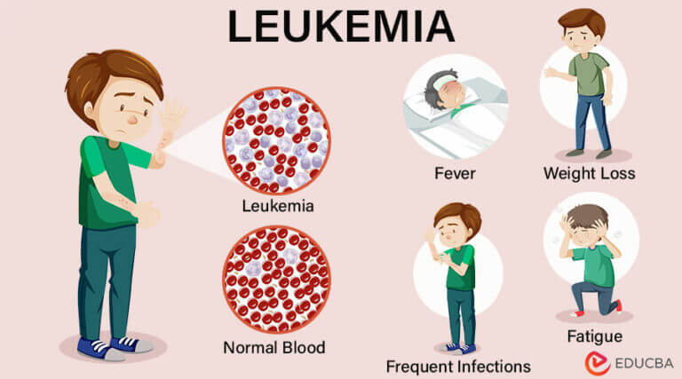 Leukemia: Types, Causes, Symptoms, Prevention & Living