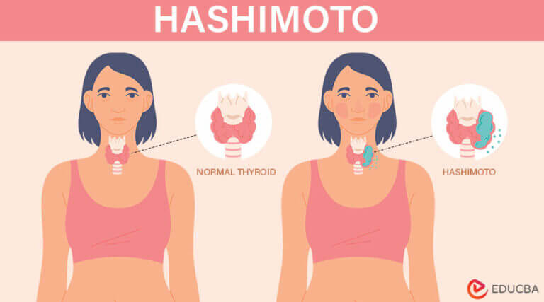 Hashimoto: Thyroiditis, Causes, Symptoms & Diagnosis