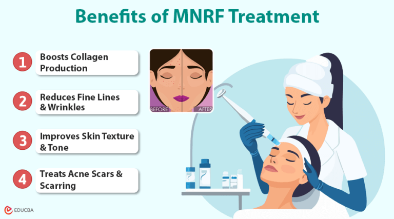 Guide to MNRF Treatment | Process, Benefits & After Effects