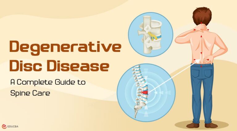 Degenerative Disc Disease | Symptoms, Causes, & Care